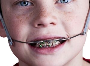 Buitenboord beugel | Orthodontiepraktijk Leidsche Rijn
